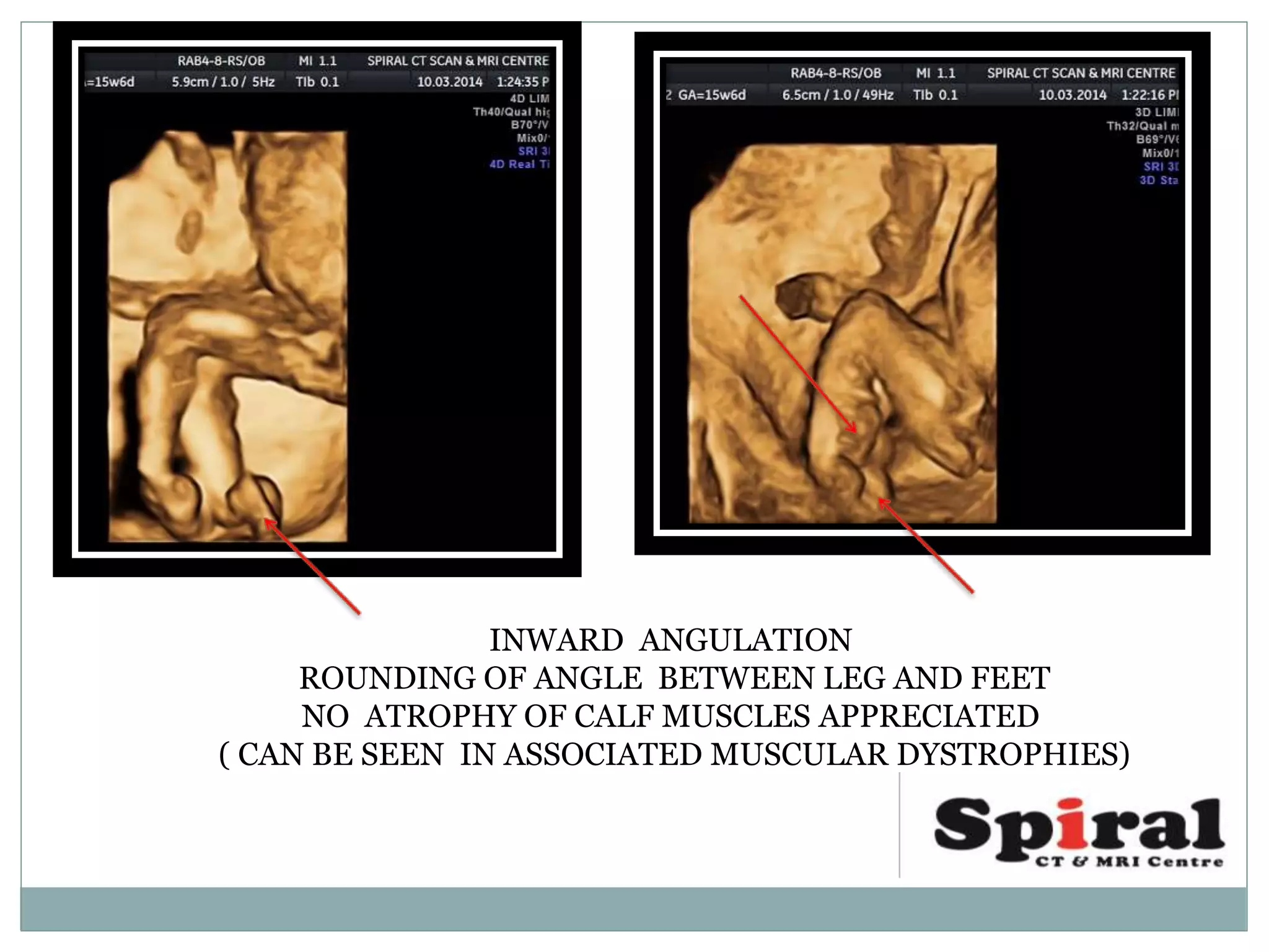 ADVANCED USG LOUNGE FETAL FEET | PPTX