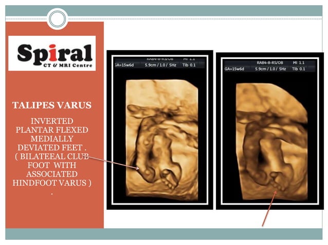 ADVANCED USG LOUNGE FETAL FEET | PPT