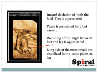 ADVANCED USG LOUNGE FETAL FEET | PPTX