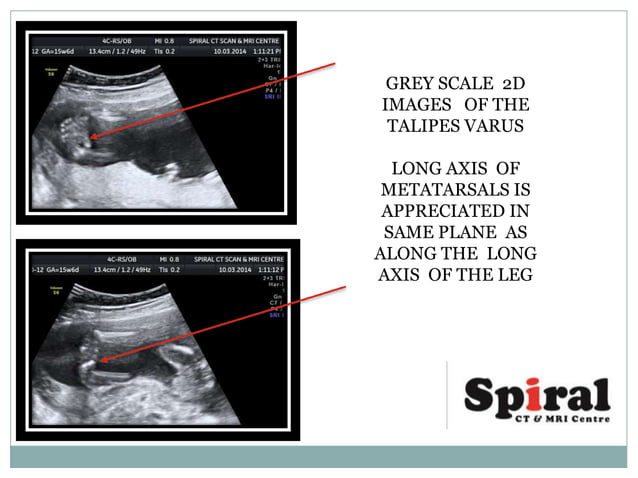 ADVANCED USG LOUNGE FETAL FEET | PPT