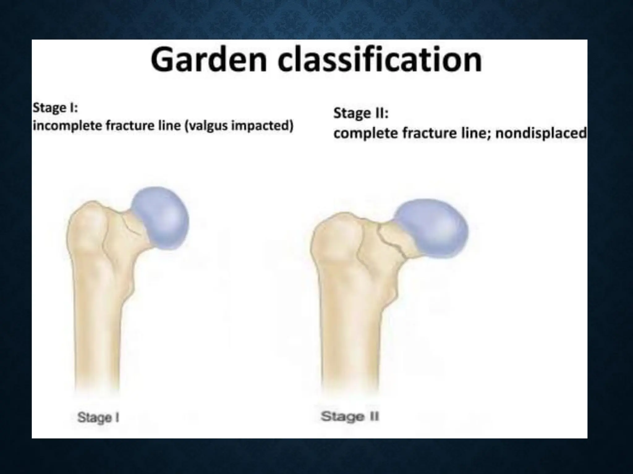 Neck of femur fracture its classification and treatment | PDF