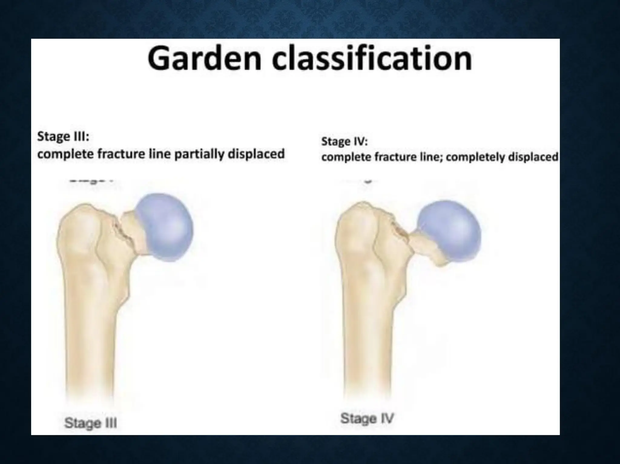 Neck of femur fracture its classification and treatment | PPT