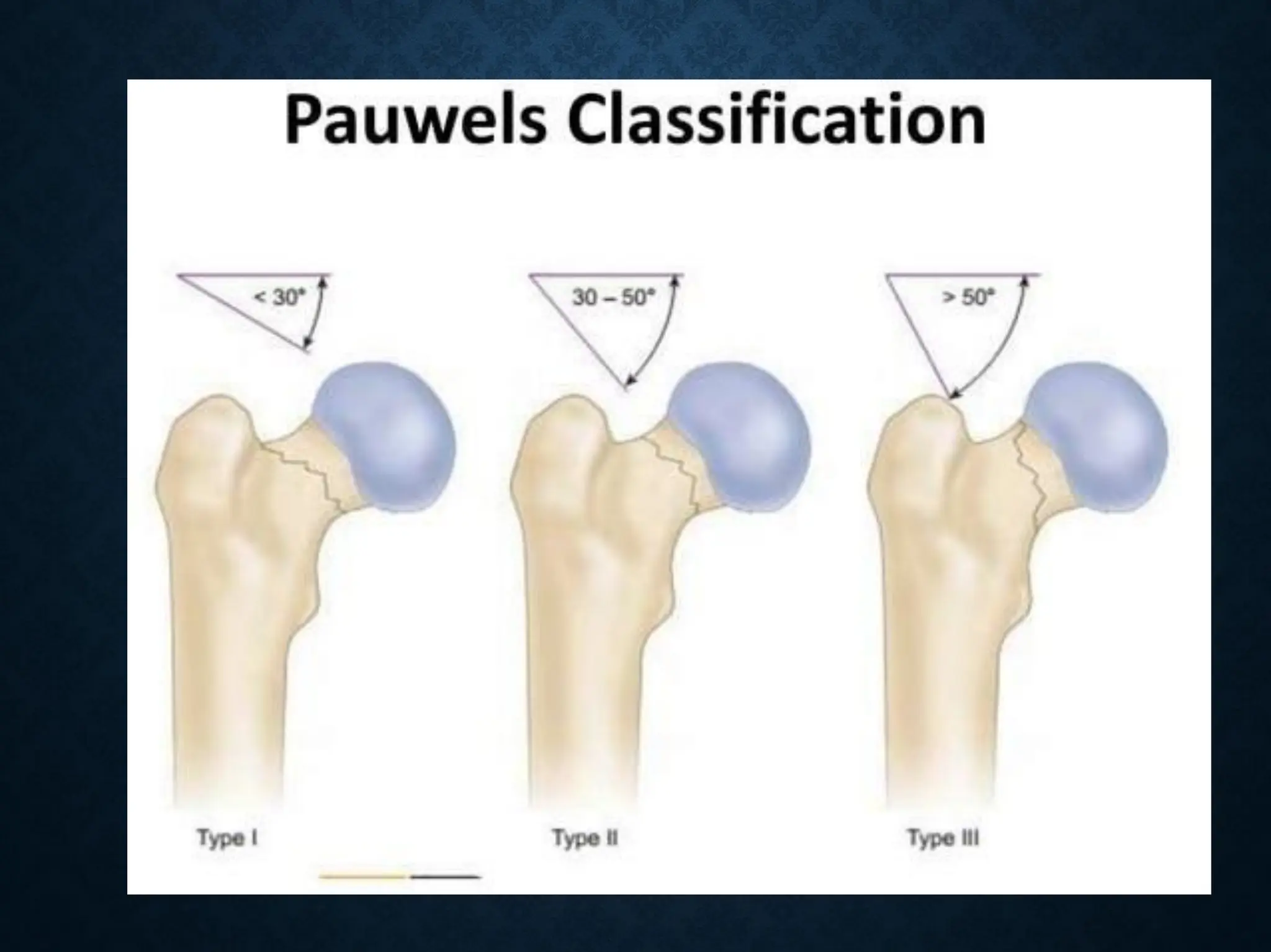 Neck of femur fracture its classification and treatment | PPT