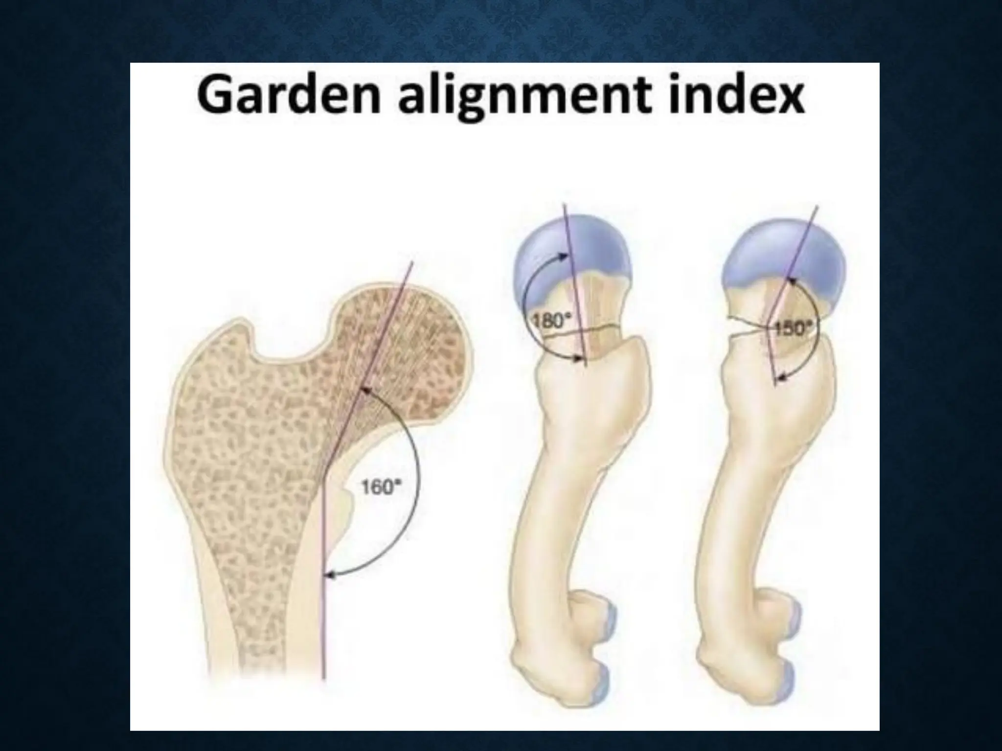 Neck of femur fracture its classification and treatment | PPT