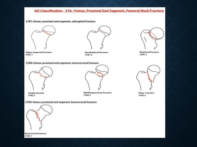 Neck of femur fracture its classification and treatment | PPT