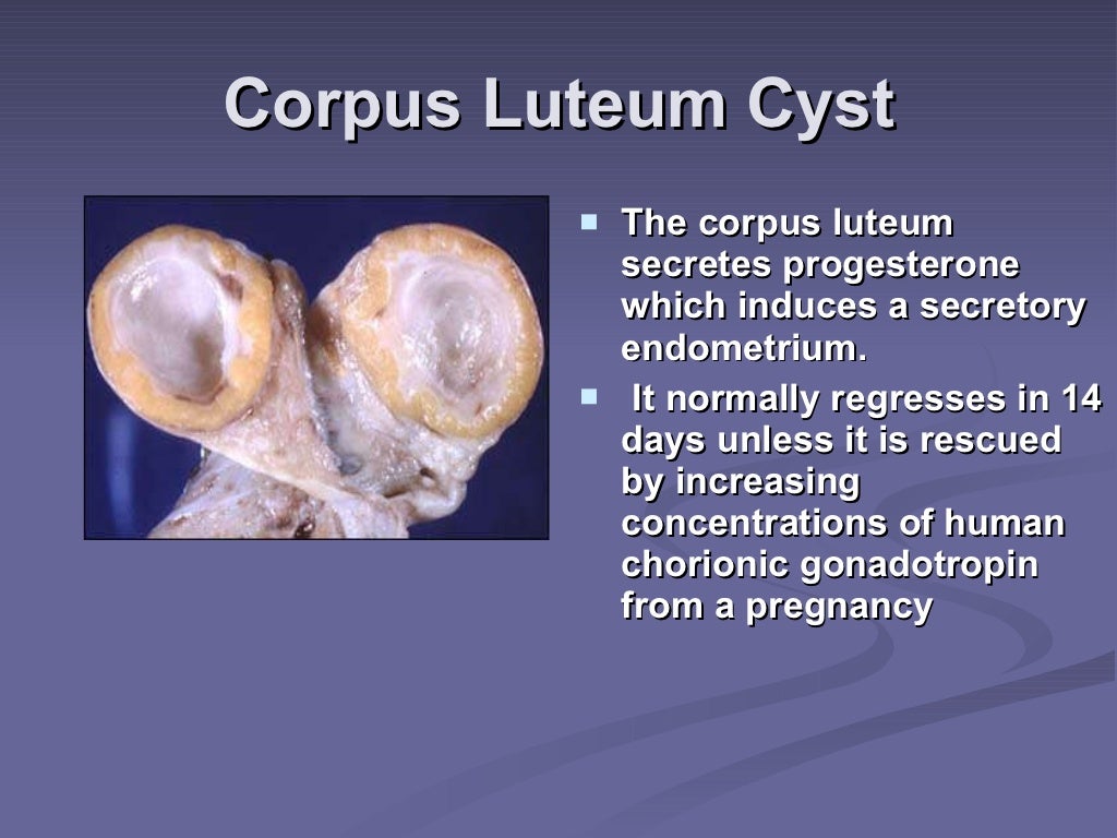 Adnexal Masses