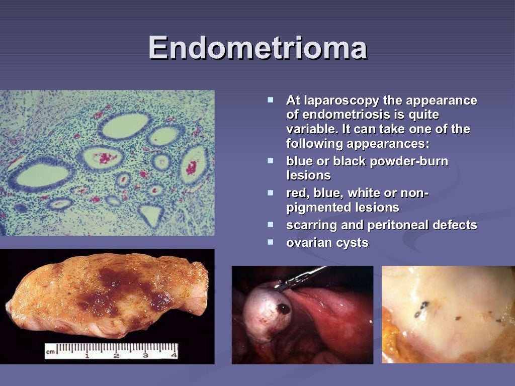 Adnexal Masses