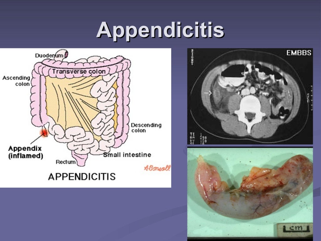 Adnexal Masses