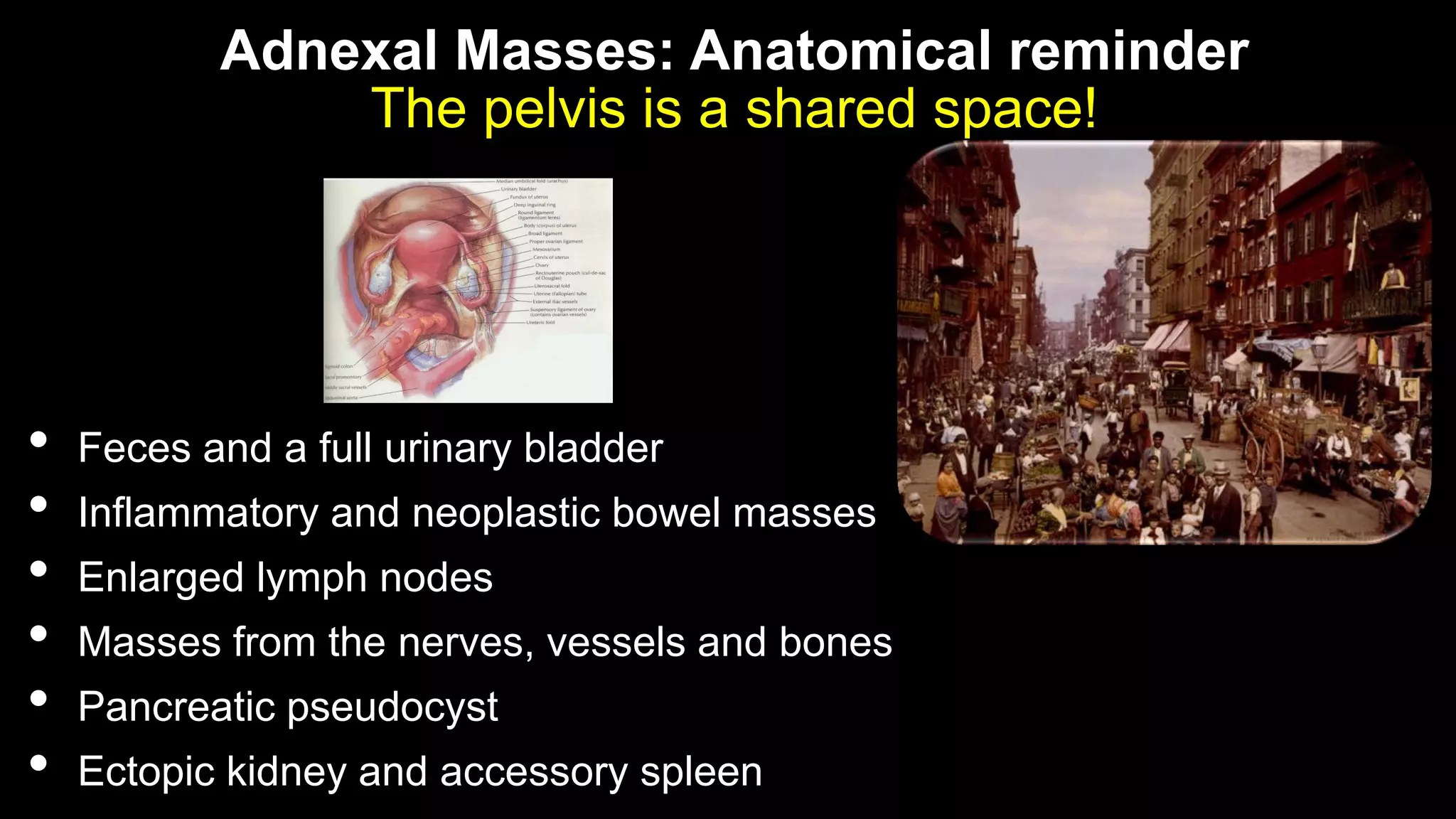 Adnexal Masses | PDF