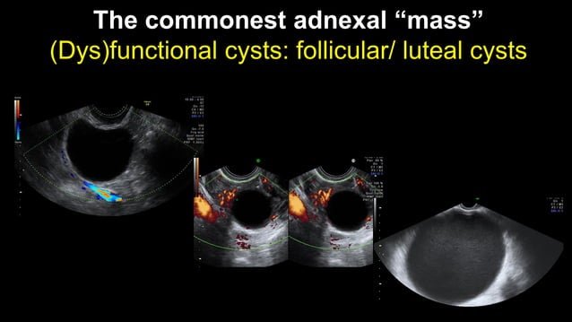 Adnexal Masses | PDF | Pregnancy | Reproductive Health