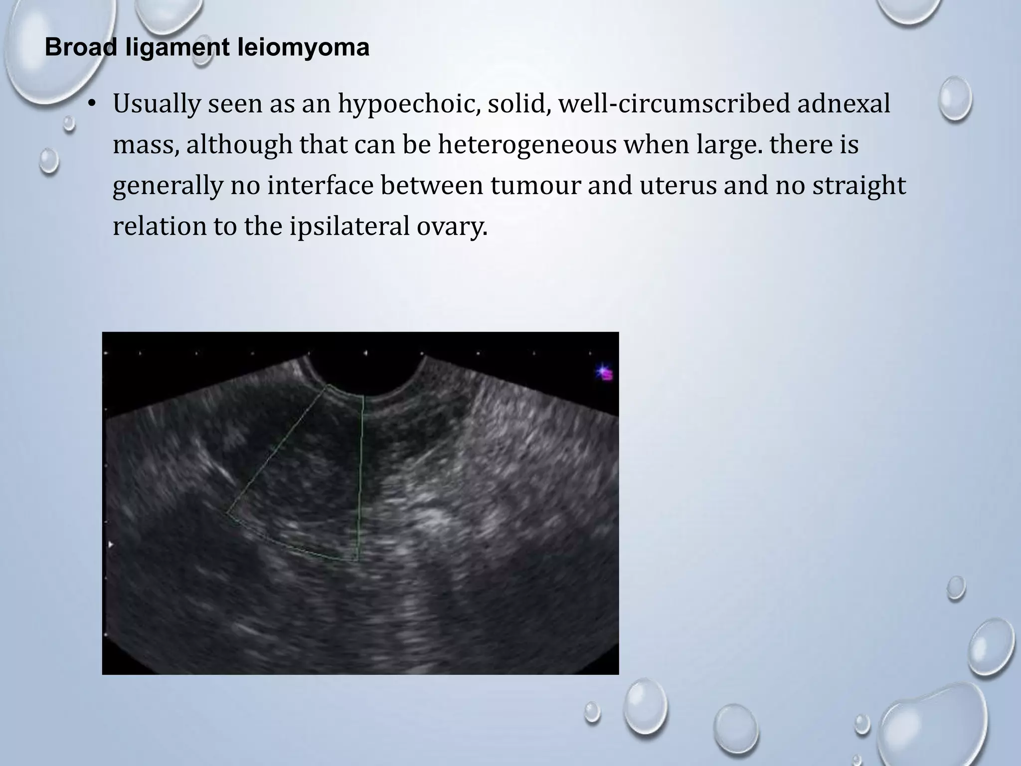 Adnexal masses | PPTX