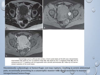 Adnexal masses | PPTX