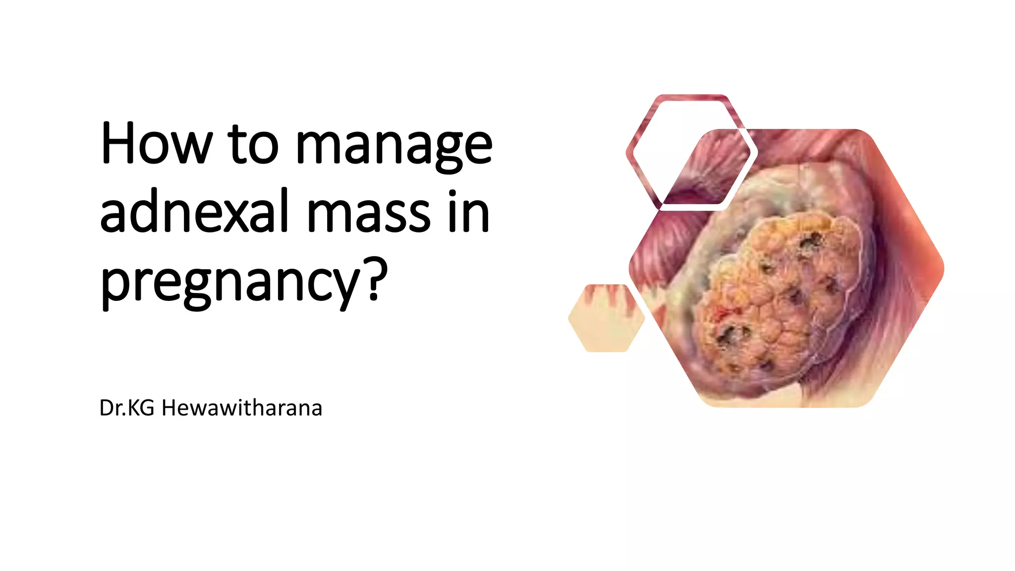Adnexal masses in pregnancy | PPTX