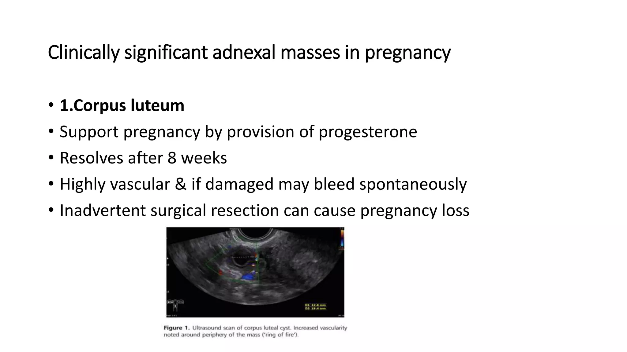 Adnexal masses in pregnancy | PPTX