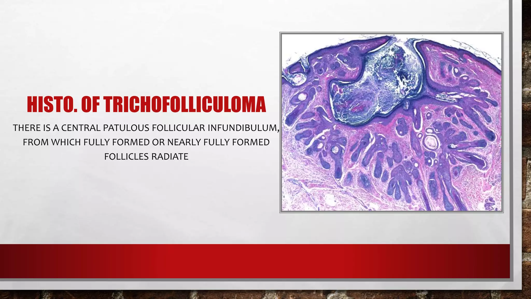 Adnexal Neoplasms | PPTX