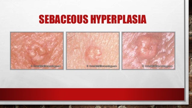 Adnexal Neoplasms