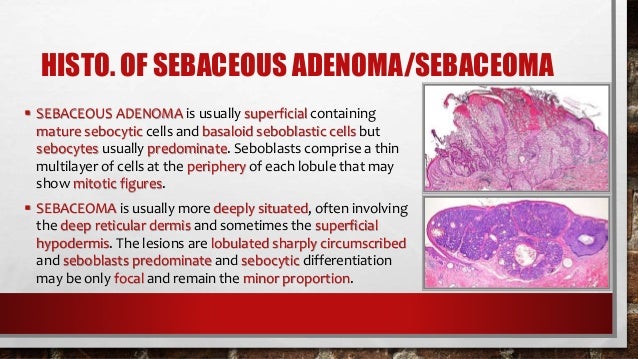 Adnexal Neoplasms
