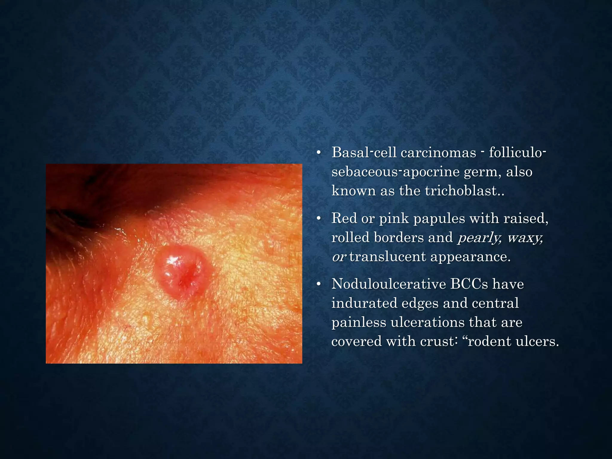 Adnexal tumours of the skin and familial syndromes. | PPTX