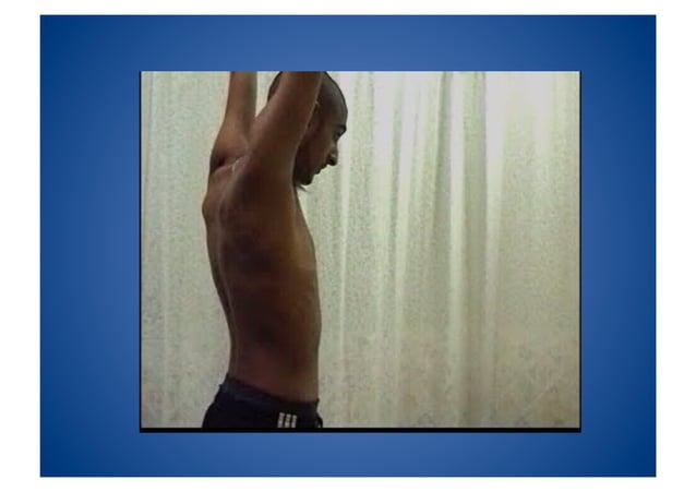 Adolescent atraumatic shoulder instability | PPT