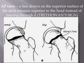 Adolescent coxa vara | PPT