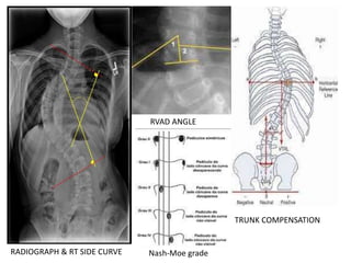 ADOLESCENT IDIOPATHIC SCOLIOSIS AND ITS ORTHOTICS MANAGEMENT.pptx