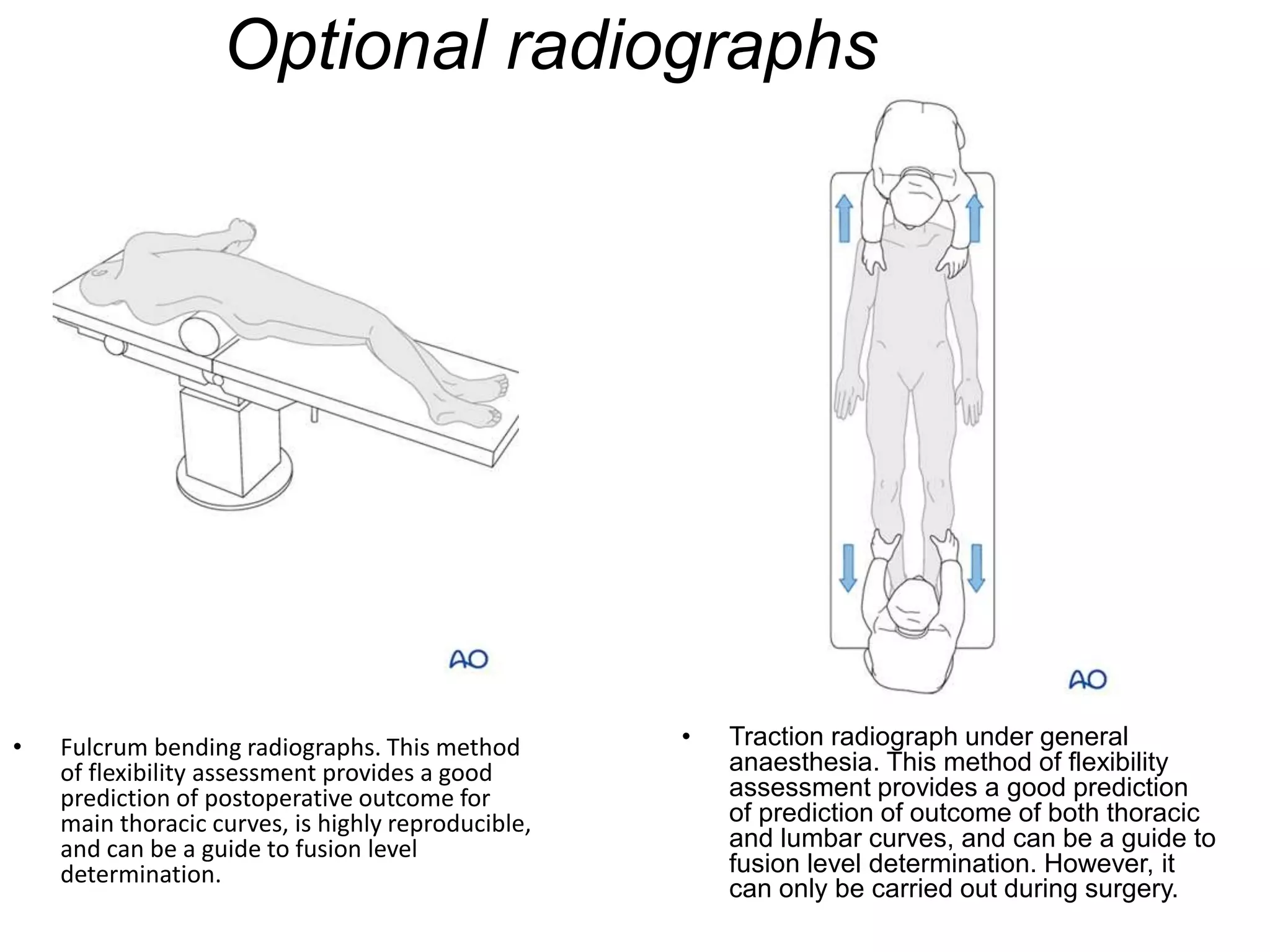 Adolescent idiopathic scoliosis patient examination | PPTX