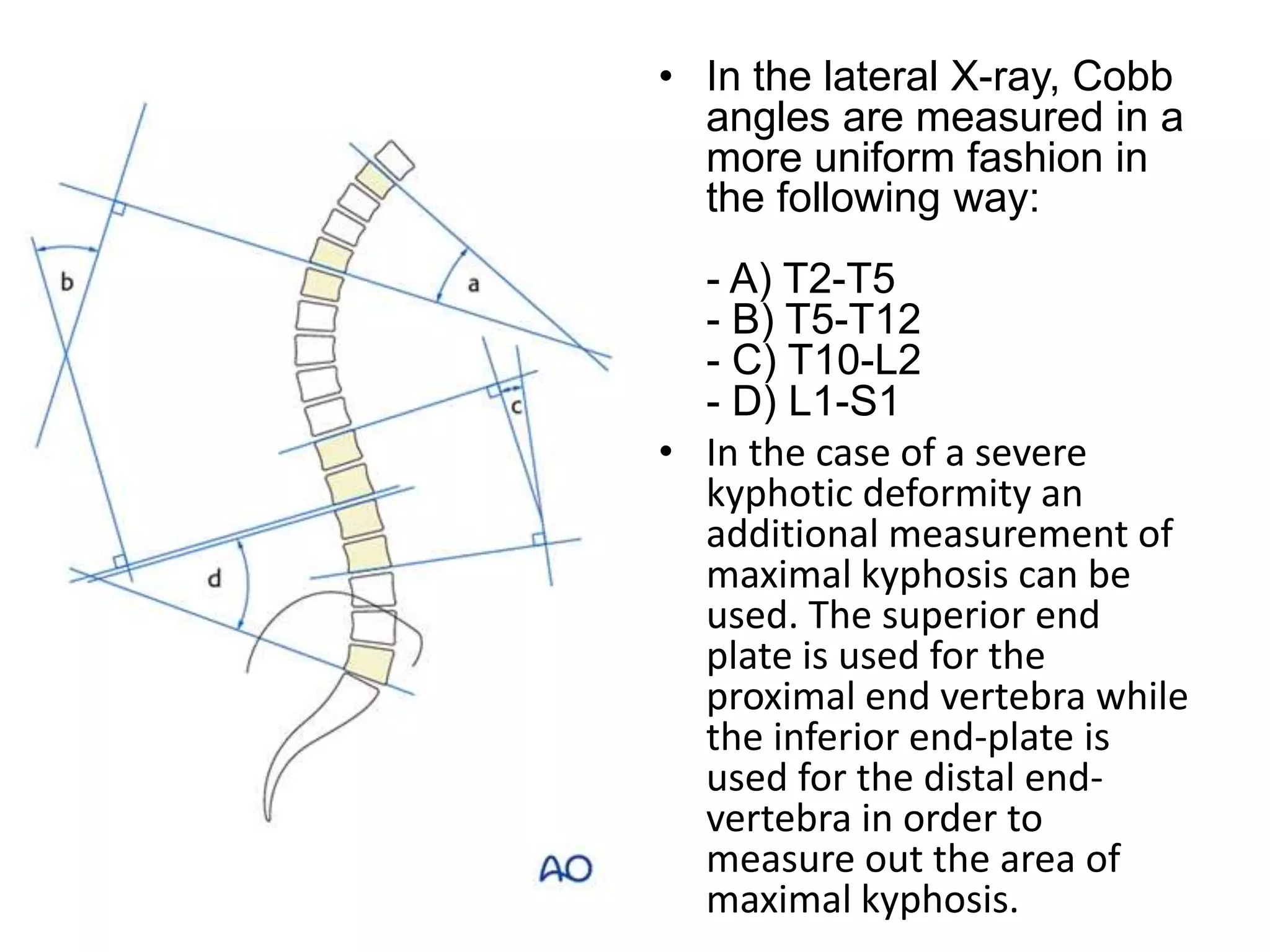 Adolescent idiopathic scoliosis patient examination | PPTX