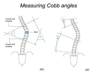 Adolescent idiopathic scoliosis patient examination | PPT