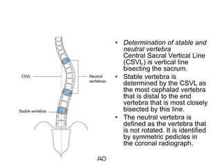 Adolescent idiopathic scoliosis patient examination | PPTX | Physical ...