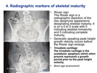 Adolescent idiopathic scoliosis patient examination | PPTX