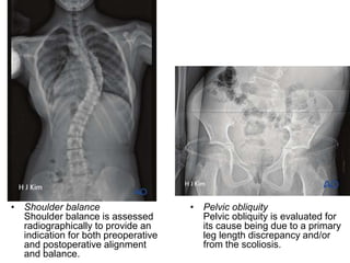 Adolescent idiopathic scoliosis patient examination | PPTX
