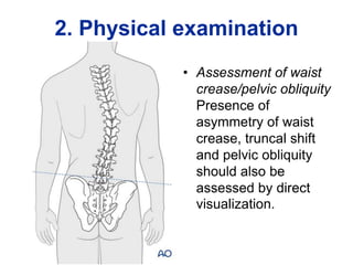 Adolescent idiopathic scoliosis patient examination | PPTX