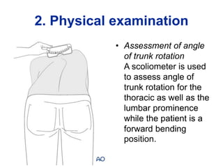 Adolescent idiopathic scoliosis patient examination | PPTX