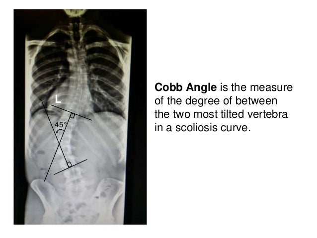 Adolescent Idiopathic Scoliosis Presentation