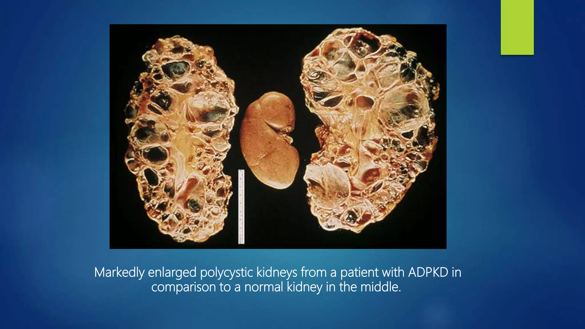 Autosomal Dominant Polycystic Kidney Disease | PPTX