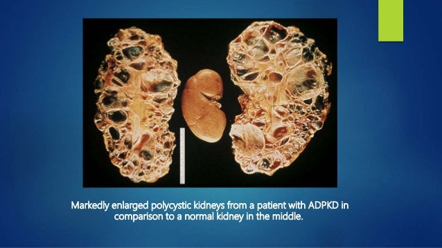 Autosomal Dominant Polycystic Kidney Disease