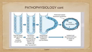 Understanding of the ADPKD FMC JABI.pptx