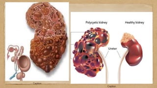 Understanding of the ADPKD FMC JABI.pptx