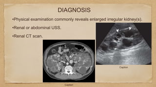 Understanding of the ADPKD FMC JABI.pptx