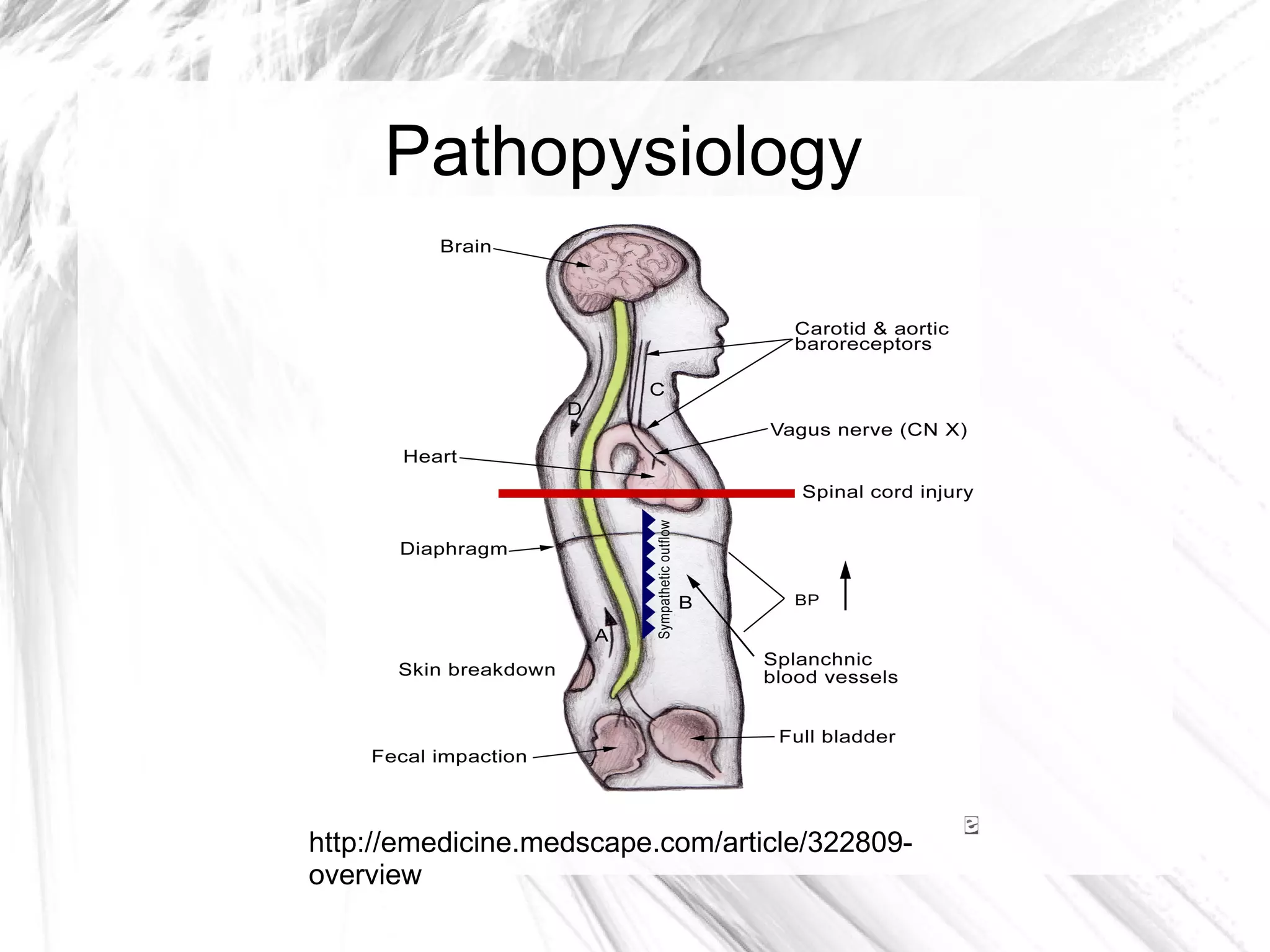 Autonomic Dysreflexia | ODP