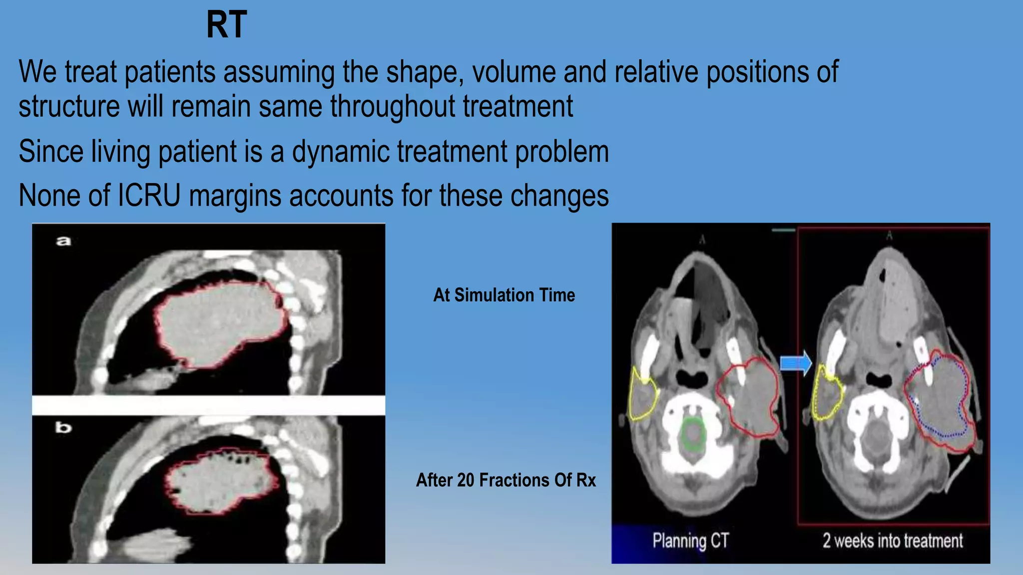 COMPLETE OVERVIEW ON ADAPTIVE RADIOTHERAPY OVER DAILY IMAGE GUIDED ...