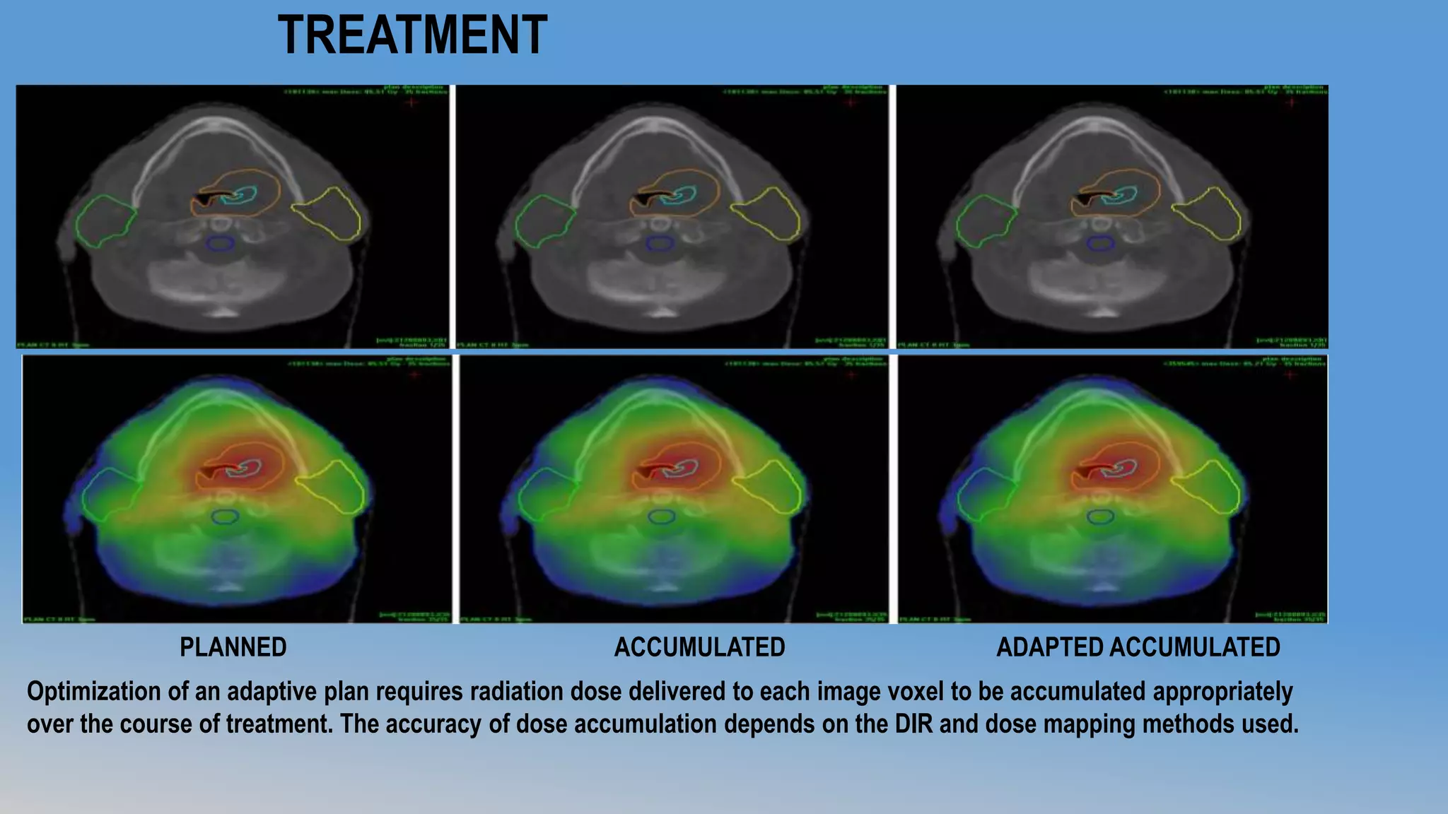 COMPLETE OVERVIEW ON ADAPTIVE RADIOTHERAPY OVER DAILY IMAGE GUIDED ...