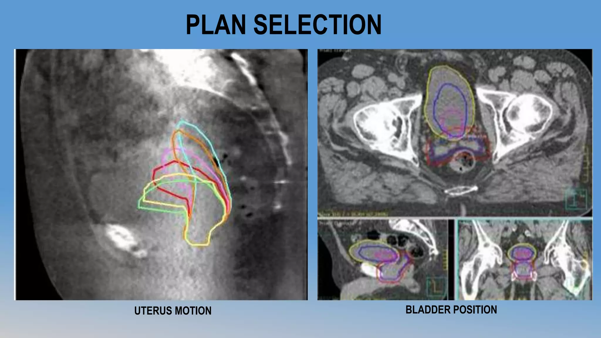 COMPLETE OVERVIEW ON ADAPTIVE RADIOTHERAPY OVER DAILY IMAGE GUIDED ...