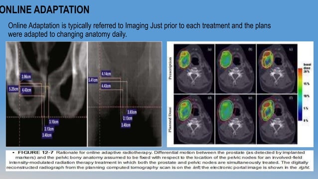 COMPLETE OVERVIEW ON ADAPTIVE RADIOTHERAPY OVER DAILY IMAGE GUIDED ...