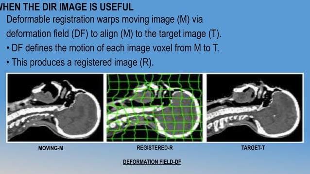 COMPLETE OVERVIEW ON ADAPTIVE RADIOTHERAPY OVER DAILY IMAGE GUIDED ...