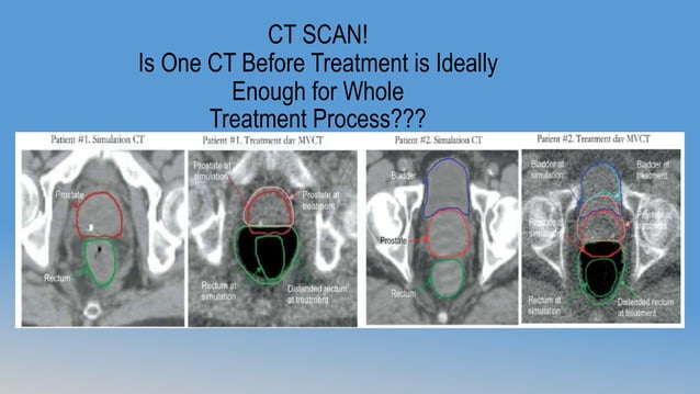 COMPLETE OVERVIEW ON ADAPTIVE RADIOTHERAPY OVER DAILY IMAGE GUIDED ...