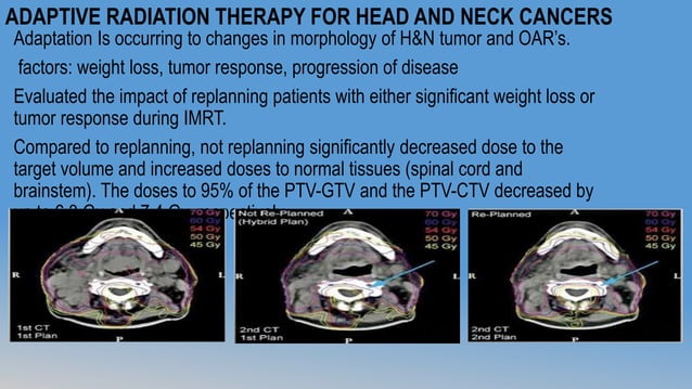 COMPLETE OVERVIEW ON ADAPTIVE RADIOTHERAPY OVER DAILY IMAGE GUIDED ...
