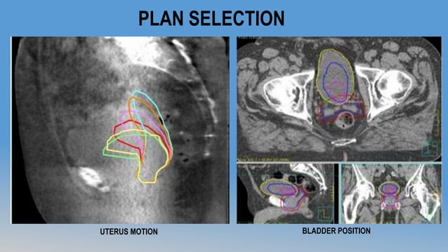 COMPLETE OVERVIEW ON ADAPTIVE RADIOTHERAPY OVER DAILY IMAGE GUIDED ...