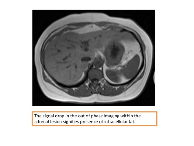 Adrenal Adenoma Radiology