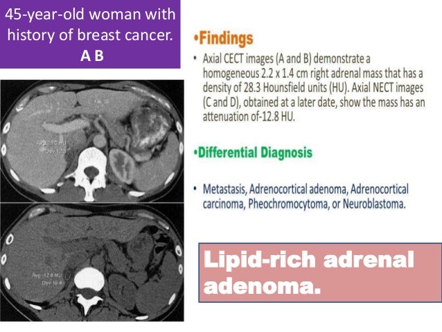 Adrenal Adenoma Radiology